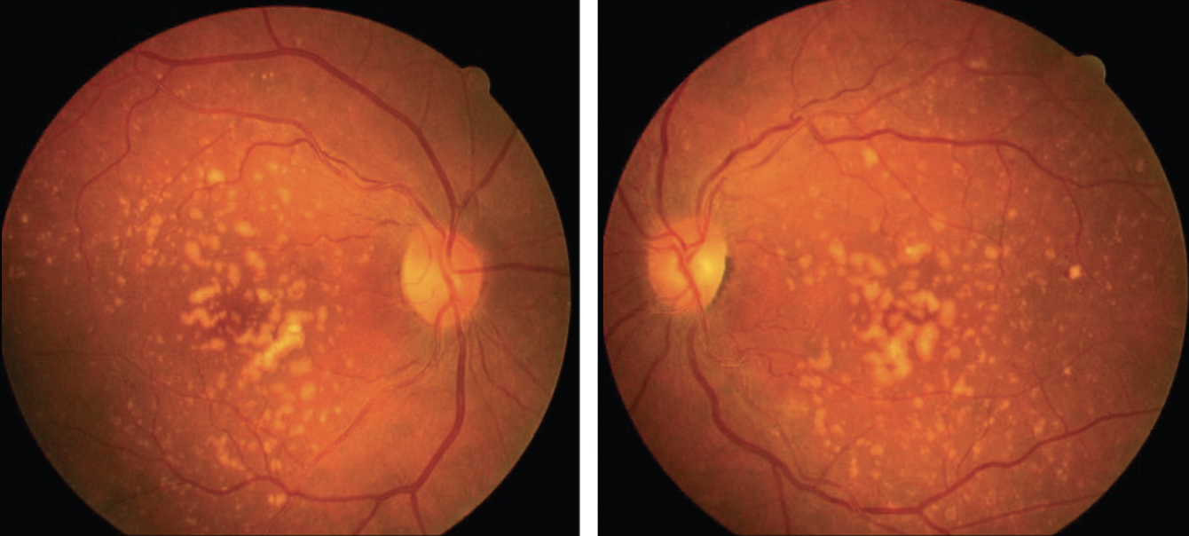 The Role of the Complement Pathway in AMD - Modern Optometry