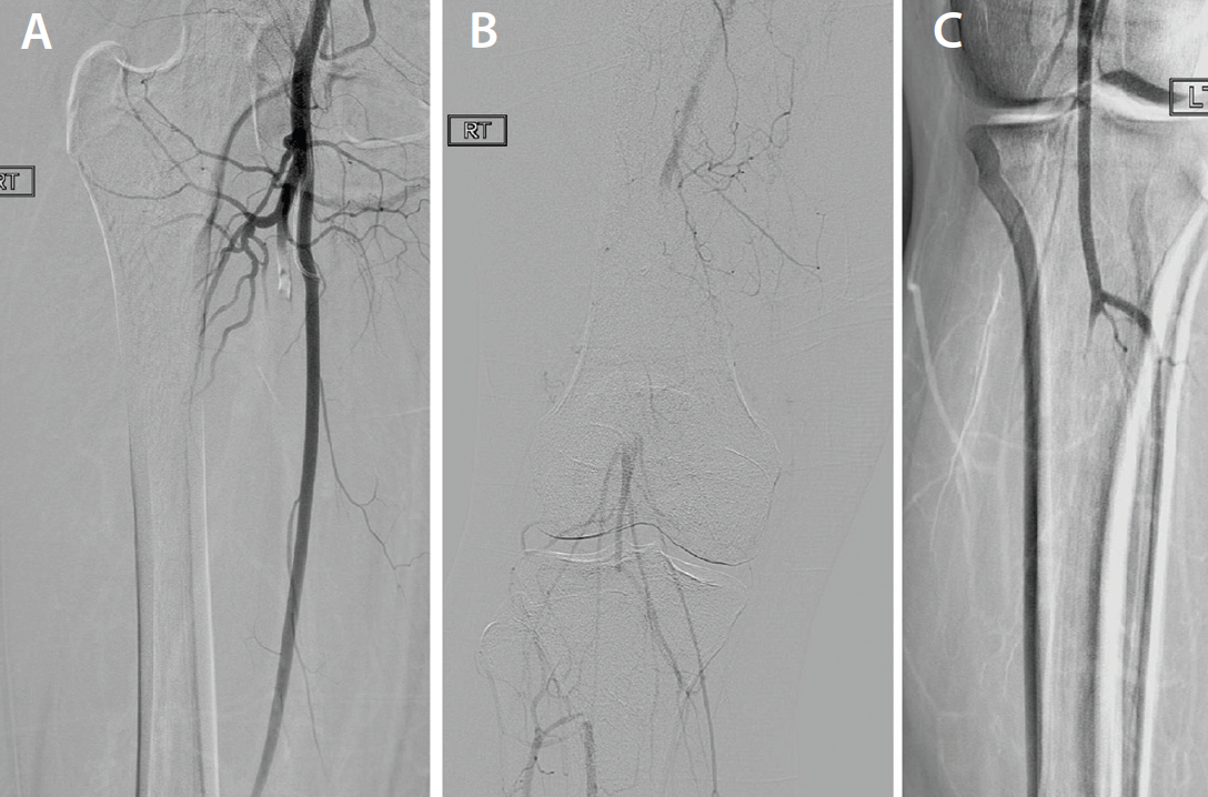 Treating Thrombotic and Embolic Occlusions With the Pounce ...