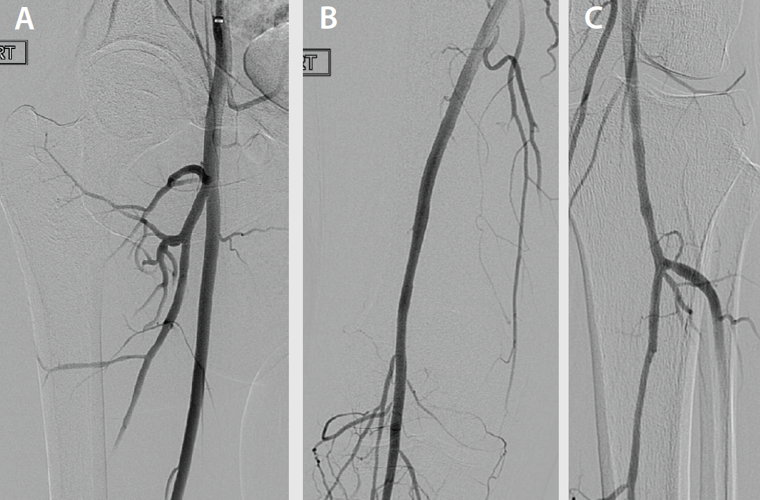 Treating Thrombotic and Embolic Occlusions With the Pounce ...