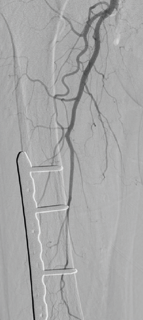 Treating Thrombotic and Embolic Occlusions With the Pounce ...
