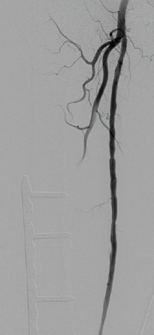 Treating Thrombotic and Embolic Occlusions With the Pounce ...