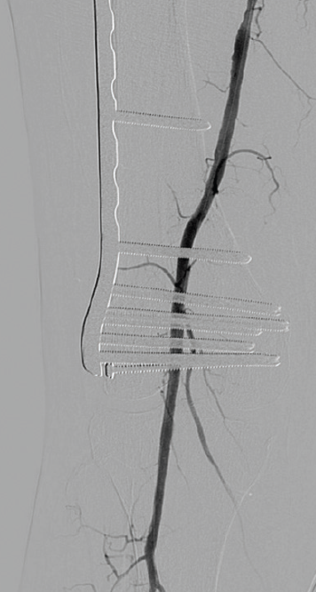 Treating Thrombotic and Embolic Occlusions With the Pounce ...