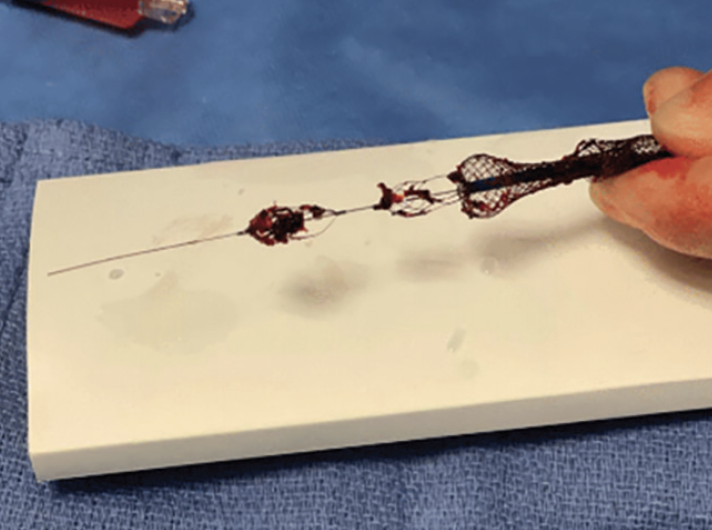 Treating Thrombotic and Embolic Occlusions With the Pounce ...