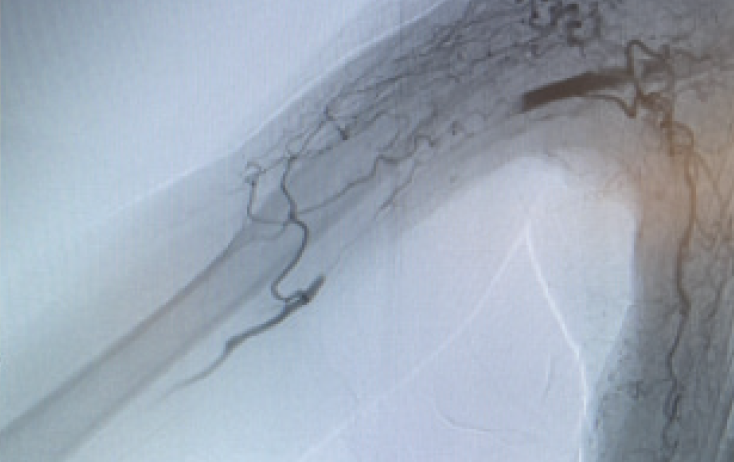 Tackling Acute-to-Chronic Thrombus and Embolus - Endovascular Today