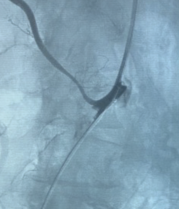 Tackling Acute-to-Chronic Thrombus and Embolus - Endovascular Today