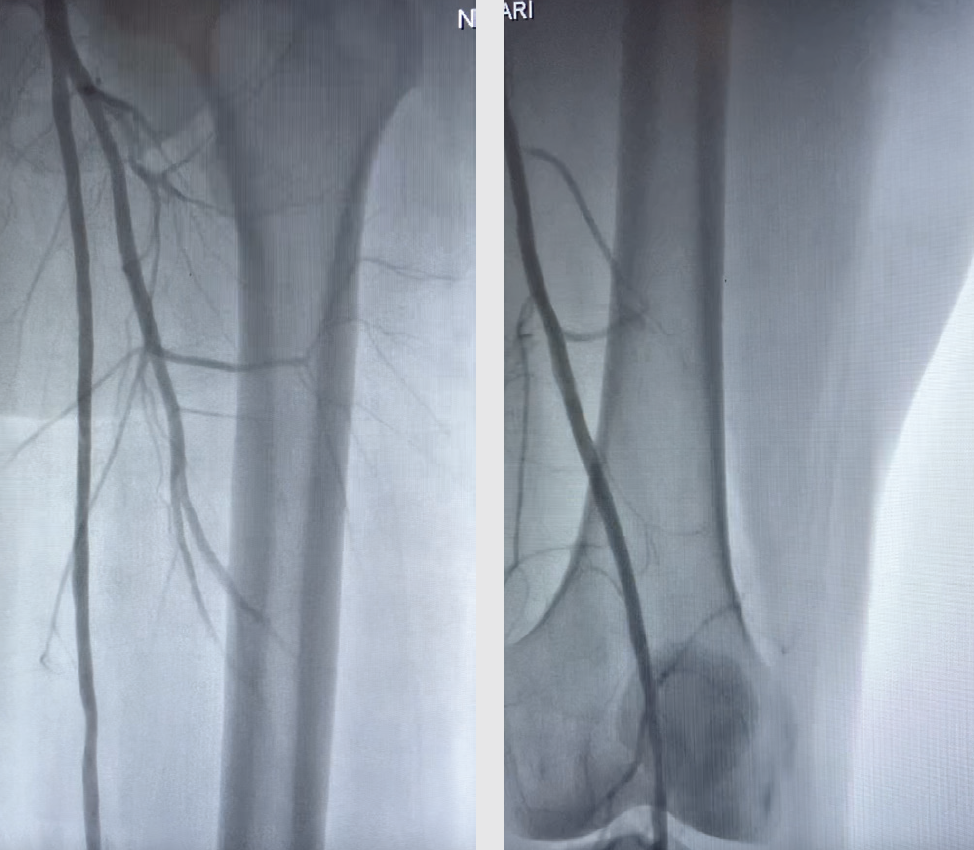 Tackling Acute-to-Chronic Thrombus and Embolus - Endovascular Today