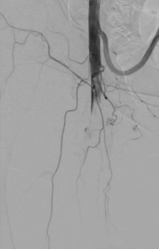 Case Report: Treatment of Focal Arterial Embolus With Stand-Alone ...