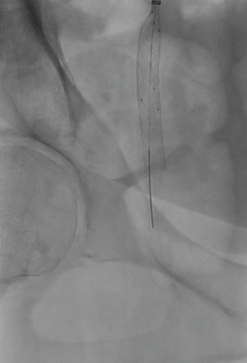 Case Report: Treatment of Focal Arterial Embolus With Stand-Alone ...