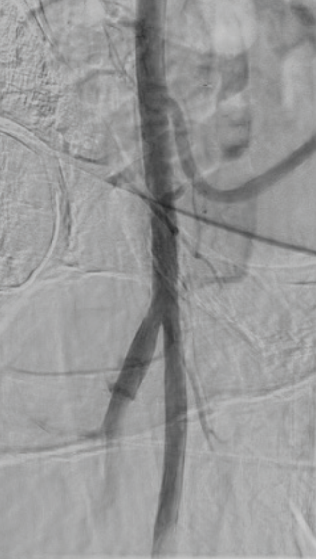 Case Report: Treatment of Focal Arterial Embolus With Stand-Alone ...