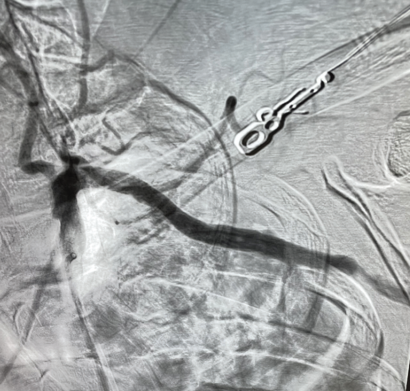 Case Report: Novel Use of the Pounce™ Thrombectomy System for Acute ...