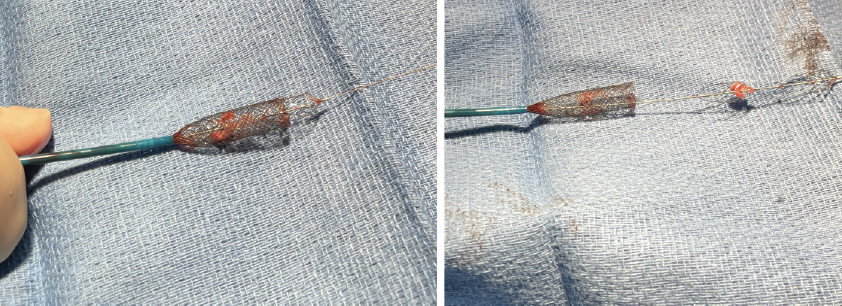 Case Report: Novel Use of the Pounce™ Thrombectomy System for Acute ...