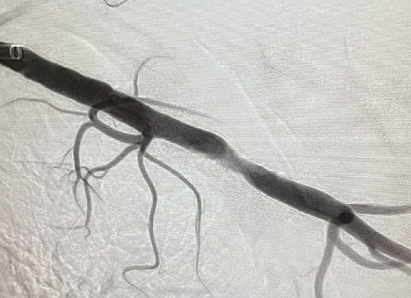 Case Report: Novel Use of the Pounce™ Thrombectomy System for Acute ...