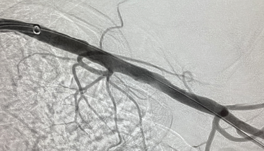 Case Report: Novel Use of the Pounce™ Thrombectomy System for Acute ...