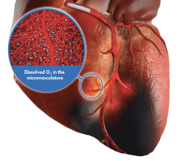 SuperSaturated Oxygen Therapy: Cases and Cocktails Event Winning ...