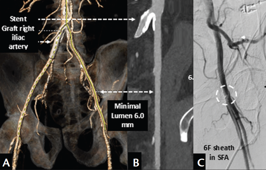 Navitor With NaviSeal™ Cuff - Cardiac Interventions Today