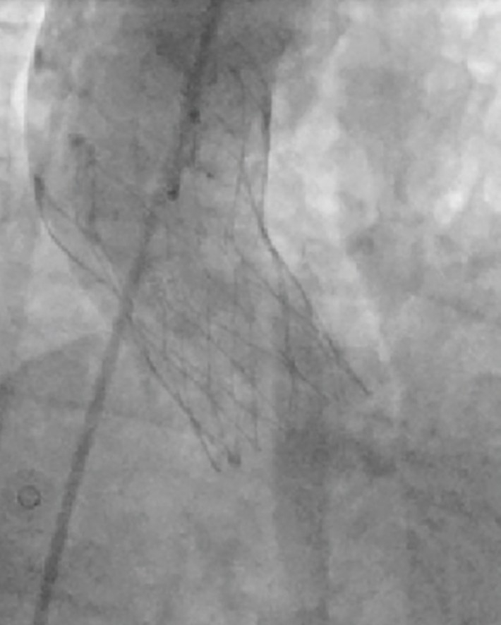 Navitor With NaviSeal™ Cuff - Cardiac Interventions Today