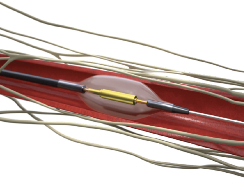 How to Denervate With Current Renal Denervation Device Iterations ...