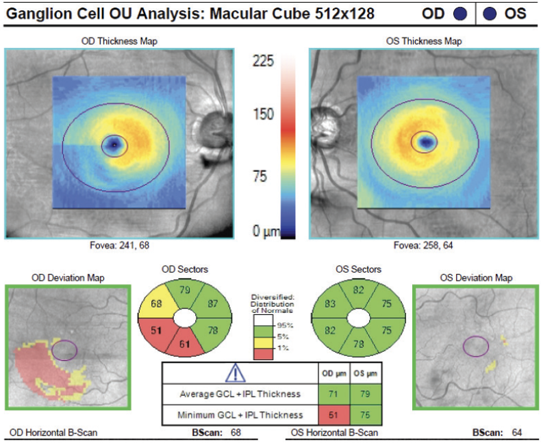 Glaucoma Diagnosis, Treatment, and Scope: a Review - Modern Optometry