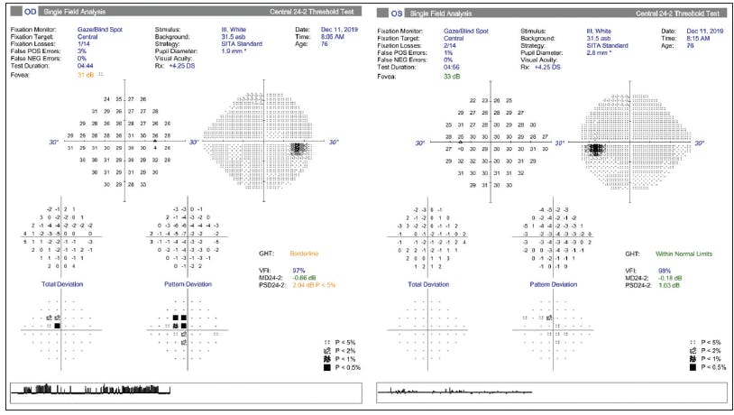 Glaucoma Diagnosis, Treatment, and Scope: a Review - Modern Optometry