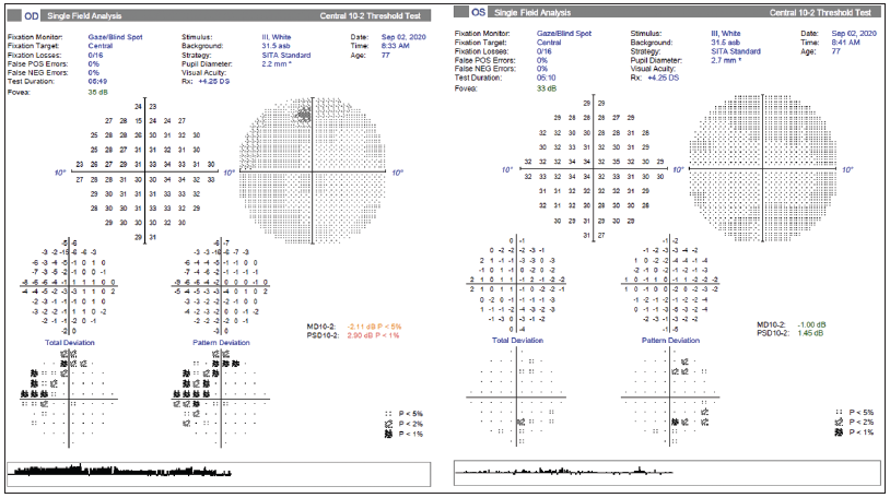 Glaucoma Diagnosis, Treatment, and Scope: a Review - Modern Optometry