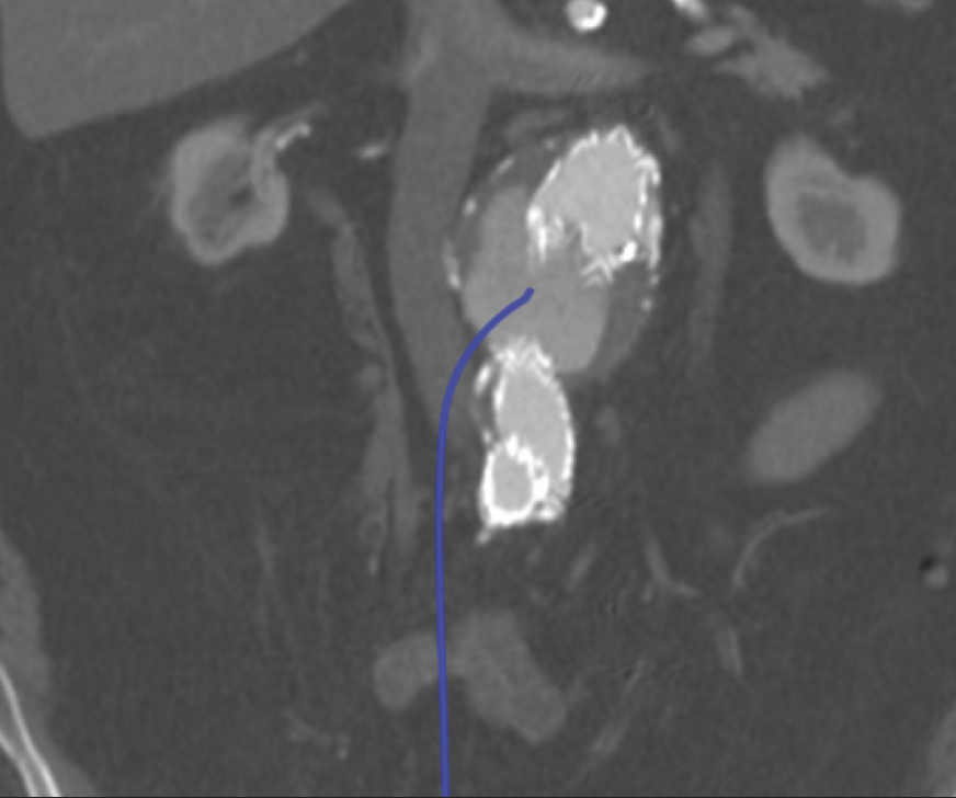 How I Do It Management Of Type Ii Endoleak With A Transcaval Approach