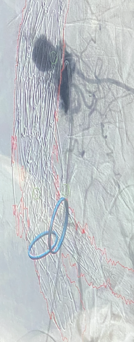 How I Do It Management Of Type Ii Endoleak With A Transcaval Approach