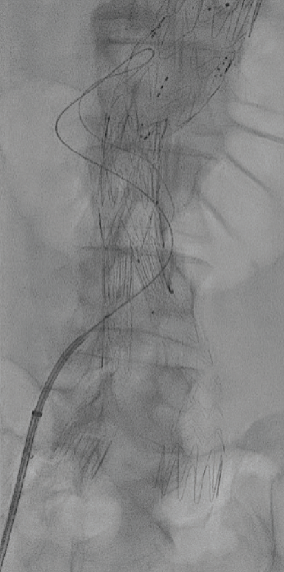 How I Do It Management Of Type Ii Endoleak With A Transcaval Approach