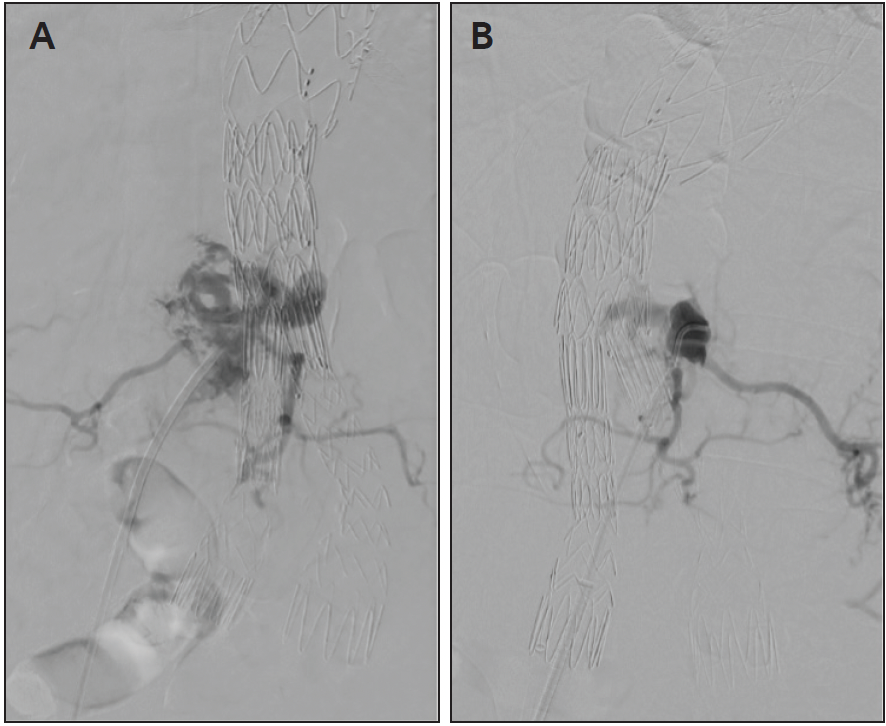 How I Do It Management Of Type Ii Endoleak With A Transcaval Approach