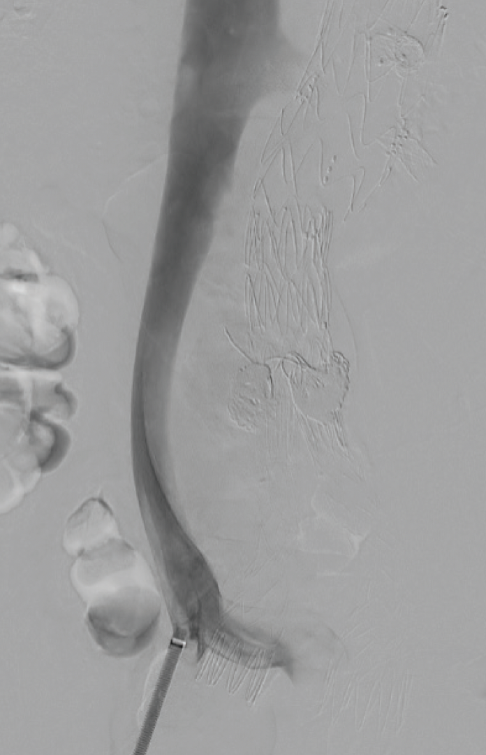How I Do It Management Of Type Ii Endoleak With A Transcaval Approach