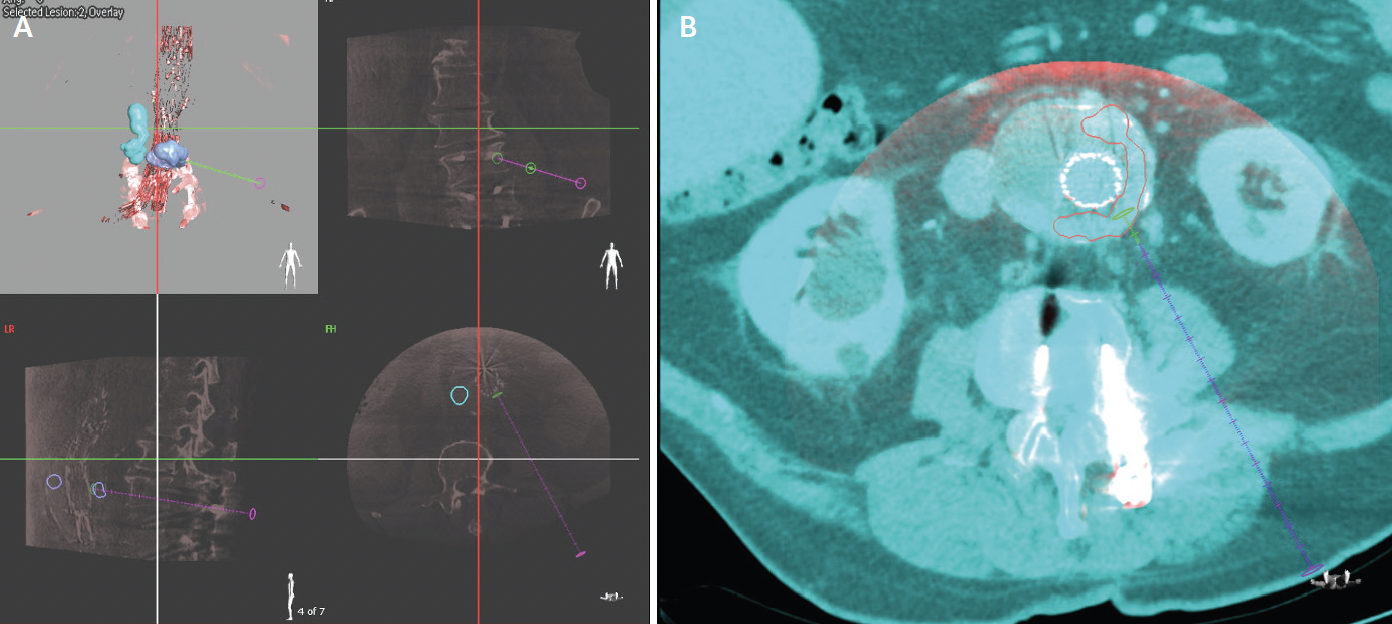 How I Do It Translumbar Approach To Type Ii Endoleak Embolization