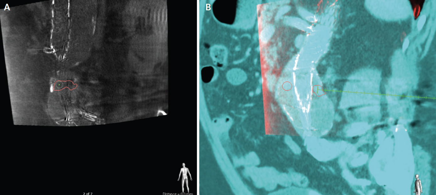 How I Do It Translumbar Approach To Type Ii Endoleak Embolization
