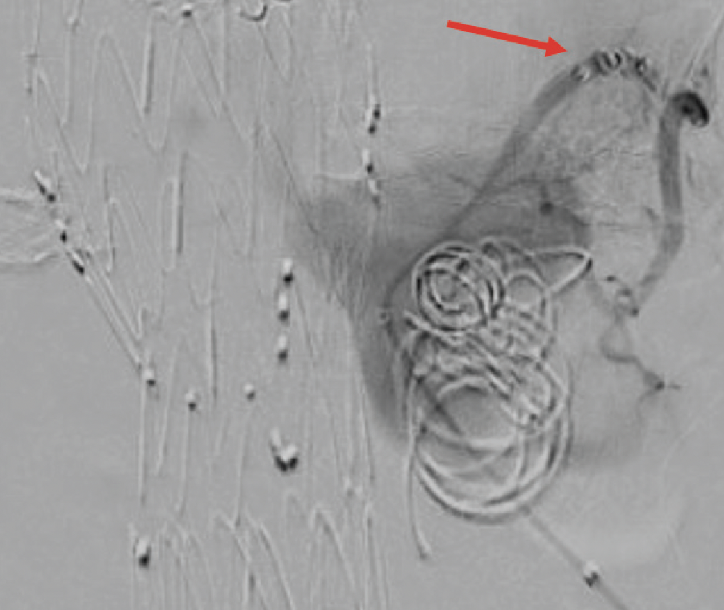 How I Do It Translumbar Approach To Type Ii Endoleak Embolization
