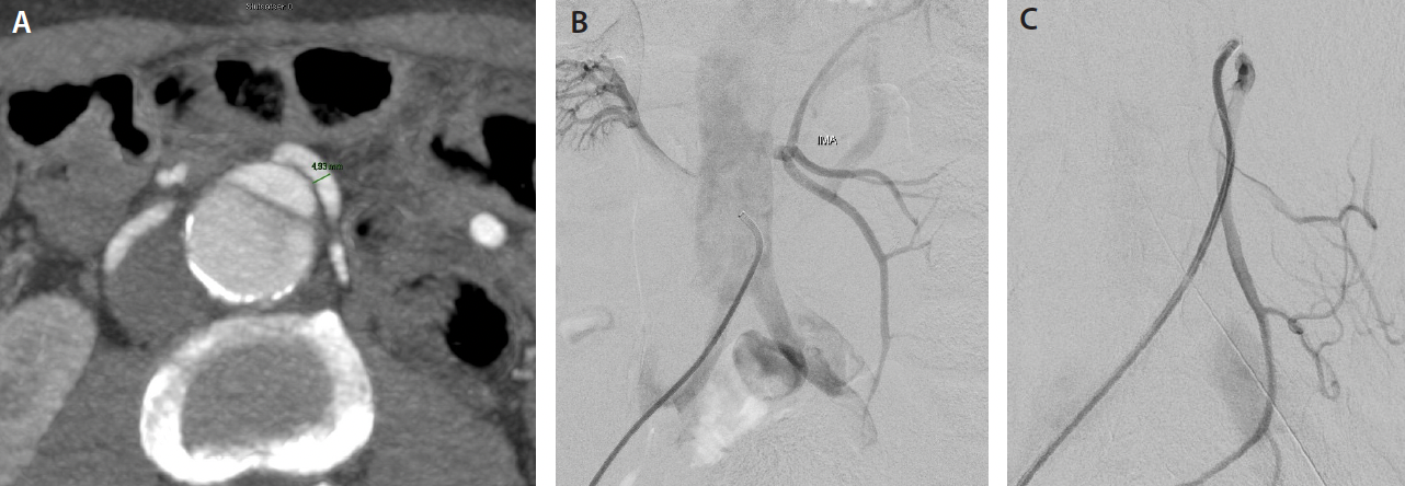 Ima Embolization During Index Evar Is It Worthwhile Endovascular Today
