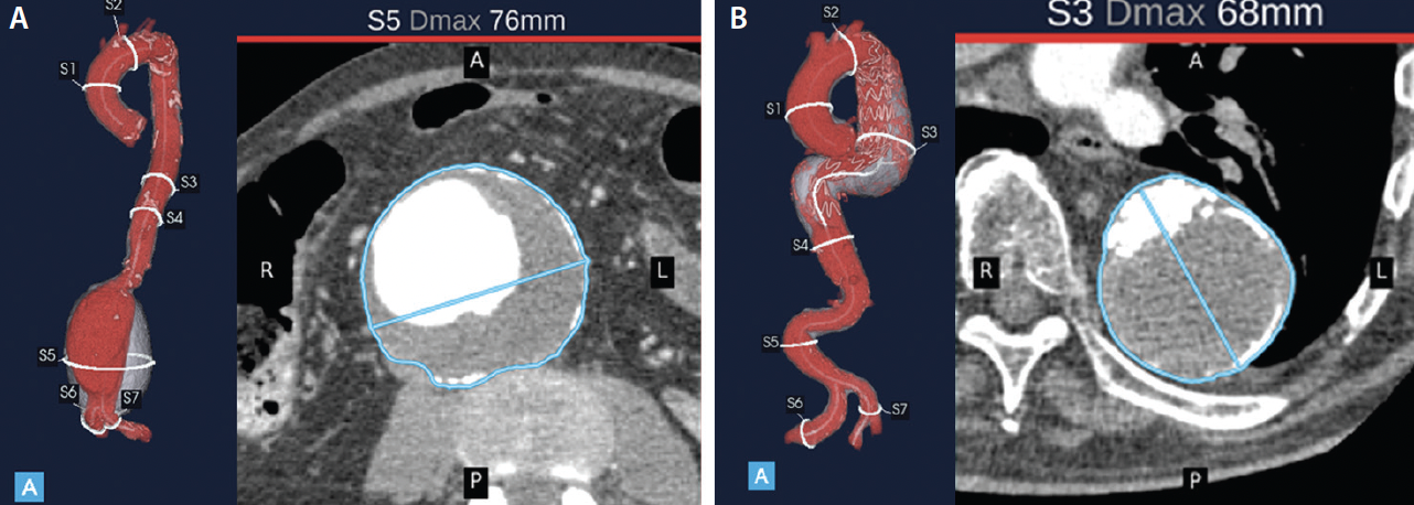 AI, Automation, and Aortic Aneurysm Care - Endovascular Today
