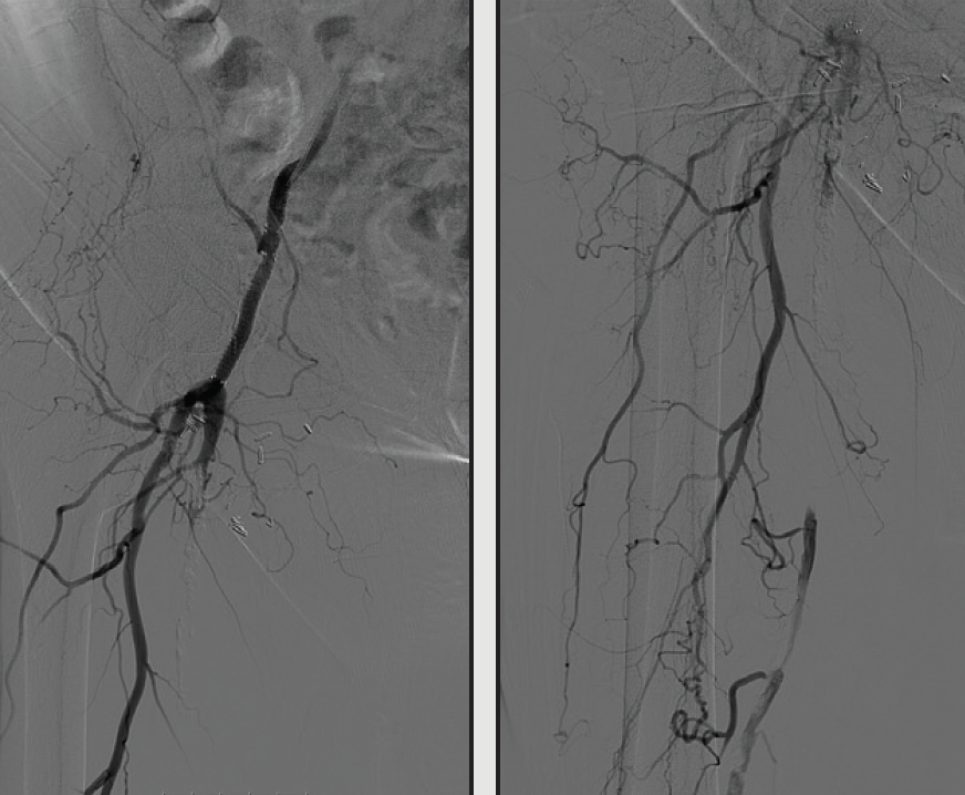 Achieving Success in Calcified SFA and Popliteal Lesions - Endovascular ...