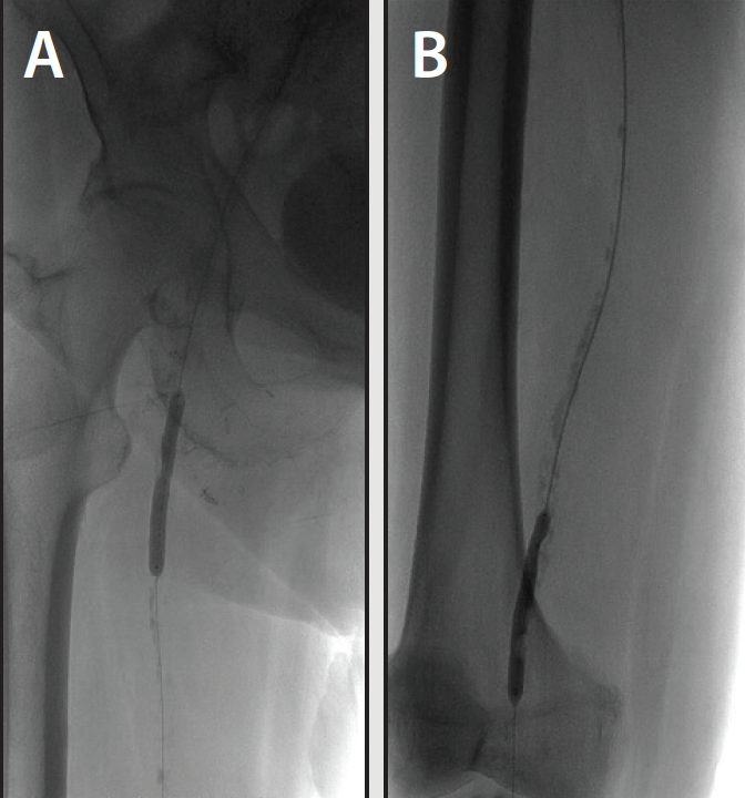 Achieving Success in Calcified SFA and Popliteal Lesions - Endovascular ...