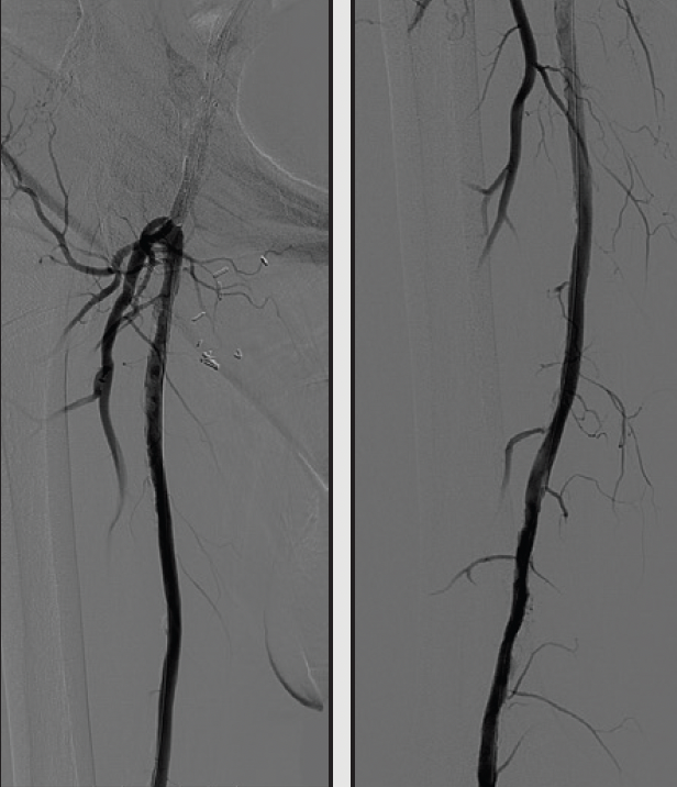 Achieving Success in Calcified SFA and Popliteal Lesions - Endovascular ...