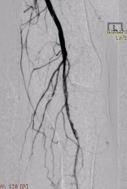 Achieving Success in Calcified SFA and Popliteal Lesions - Endovascular ...