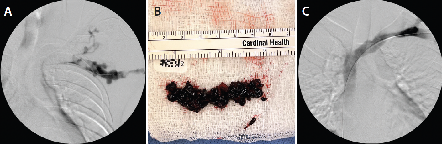 Clinical Evidence Matters: How ClotTriever Became the Most Studied ...