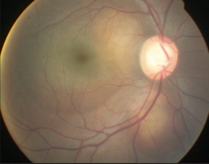Understanding Ocular Metastatic Tumors and Simulating Lesions - Modern ...
