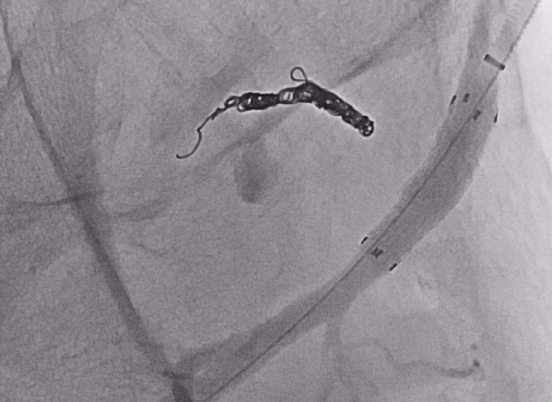 The Value of the Penumbra Coils in Trauma Management - Endovascular Today