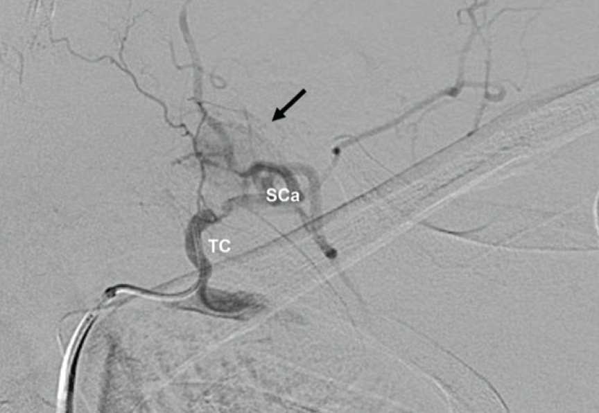 The Value of the Penumbra Coils in Trauma Management - Endovascular Today