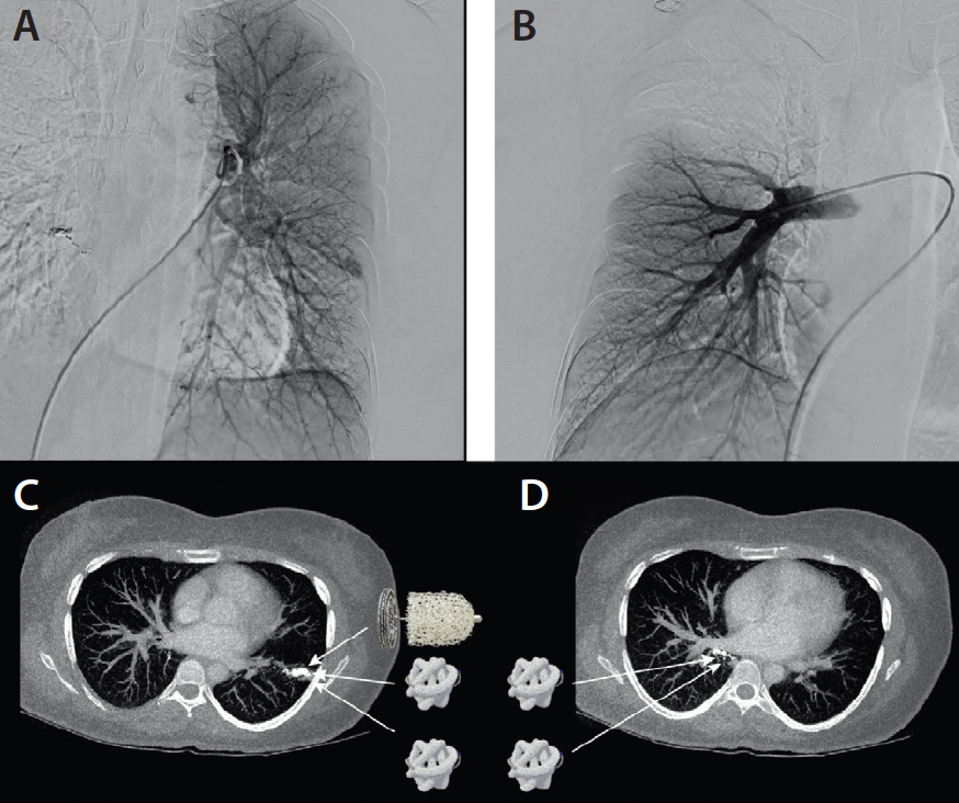 Smart Polymer: Embolization Plus - Endovascular Today