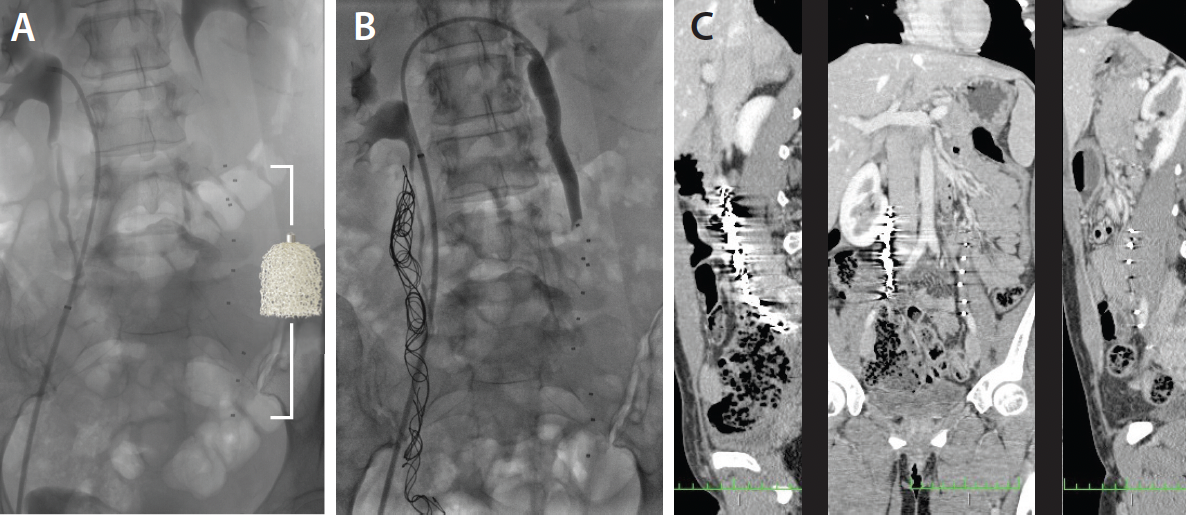 Smart Polymer: Embolization Plus - Endovascular Today