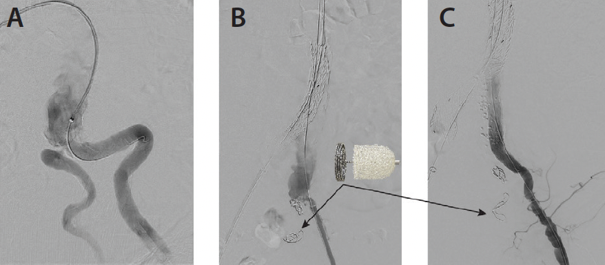 Smart Polymer: Embolization Plus - Endovascular Today