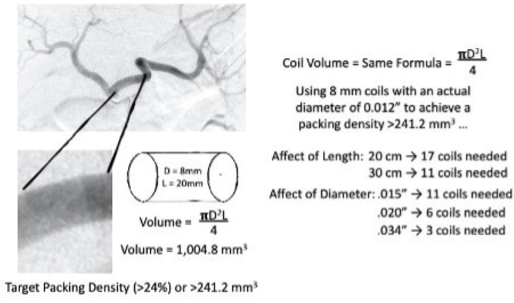 The Factors Influencing Coil Selection During Embolization Procedures ...