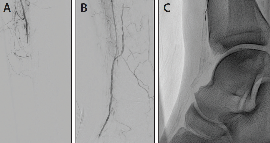 Using Serranator® in Challenging CLTI Cases - Endovascular Today