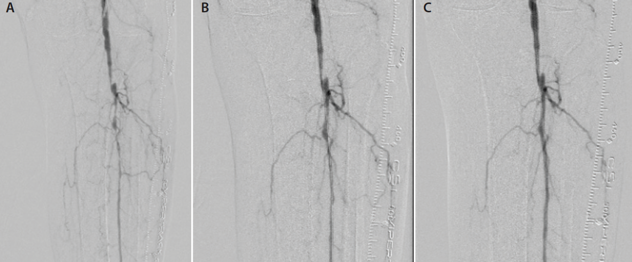 The Auryon Atherectomy System Below the Knee in Patients With Chronic ...