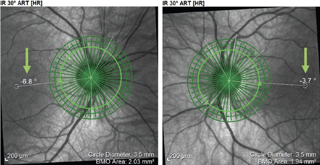 OCT Magic Trick - Modern Optometry