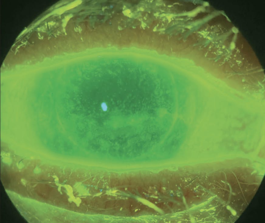 Balancing Treatment Challenges - Modern Optometry